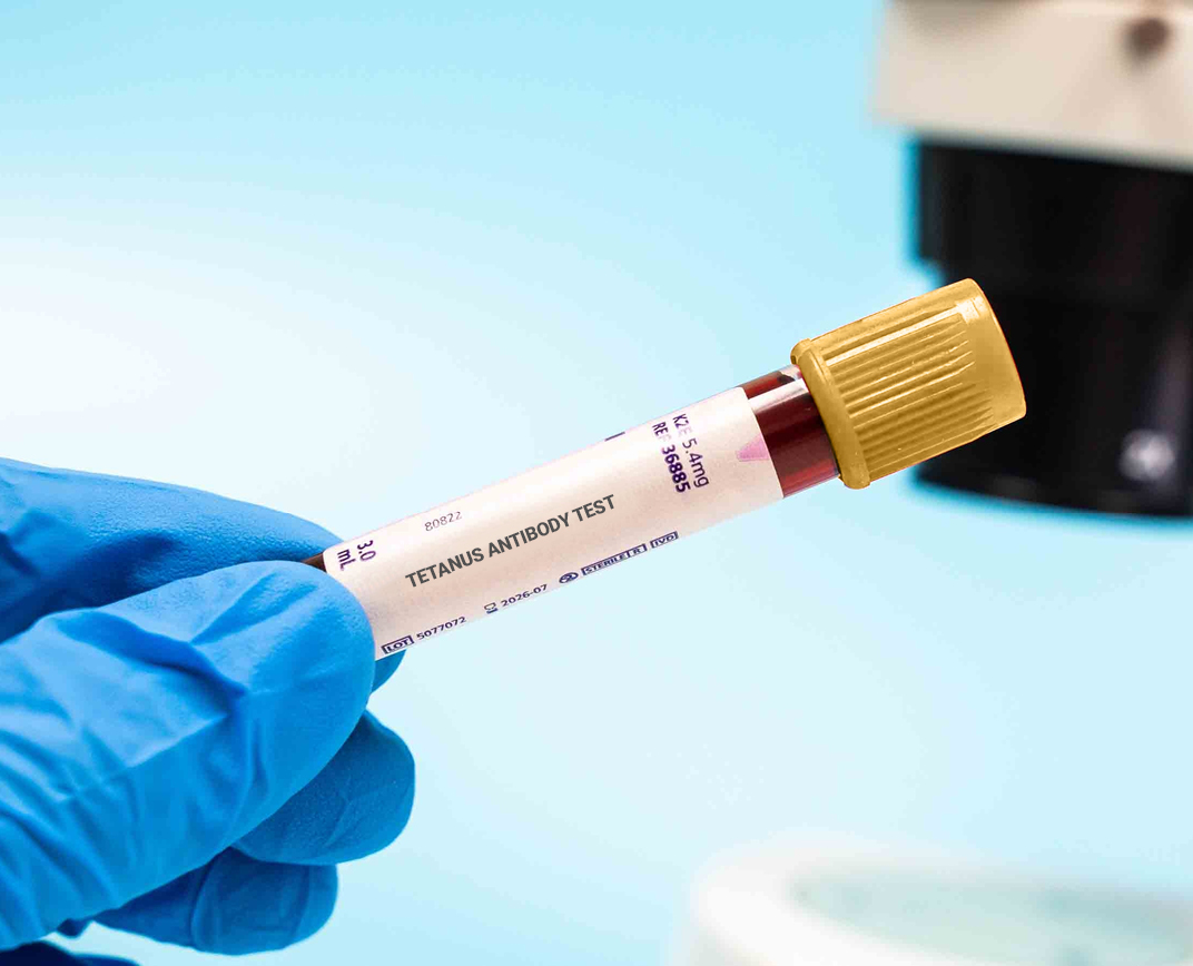 Test na protilátky - tetanus | Unilabs Online